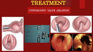 Endoscopic Ablation Of Posterior Urethral Valve Youtube