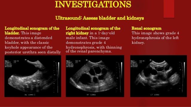 View 42 27 Antenatal Posterior Urethral Valve Radiology Gif Cdr view-42-27-antenatal-posterior-urethral-valve-radiology-gif-cdr