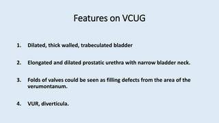 Posterior urethral valves | PPTX