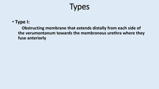 Posterior urethral valves | PPTX