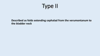 Posterior urethral valves | PPTX
