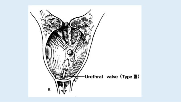 Posterior Urethral Valves Diagram