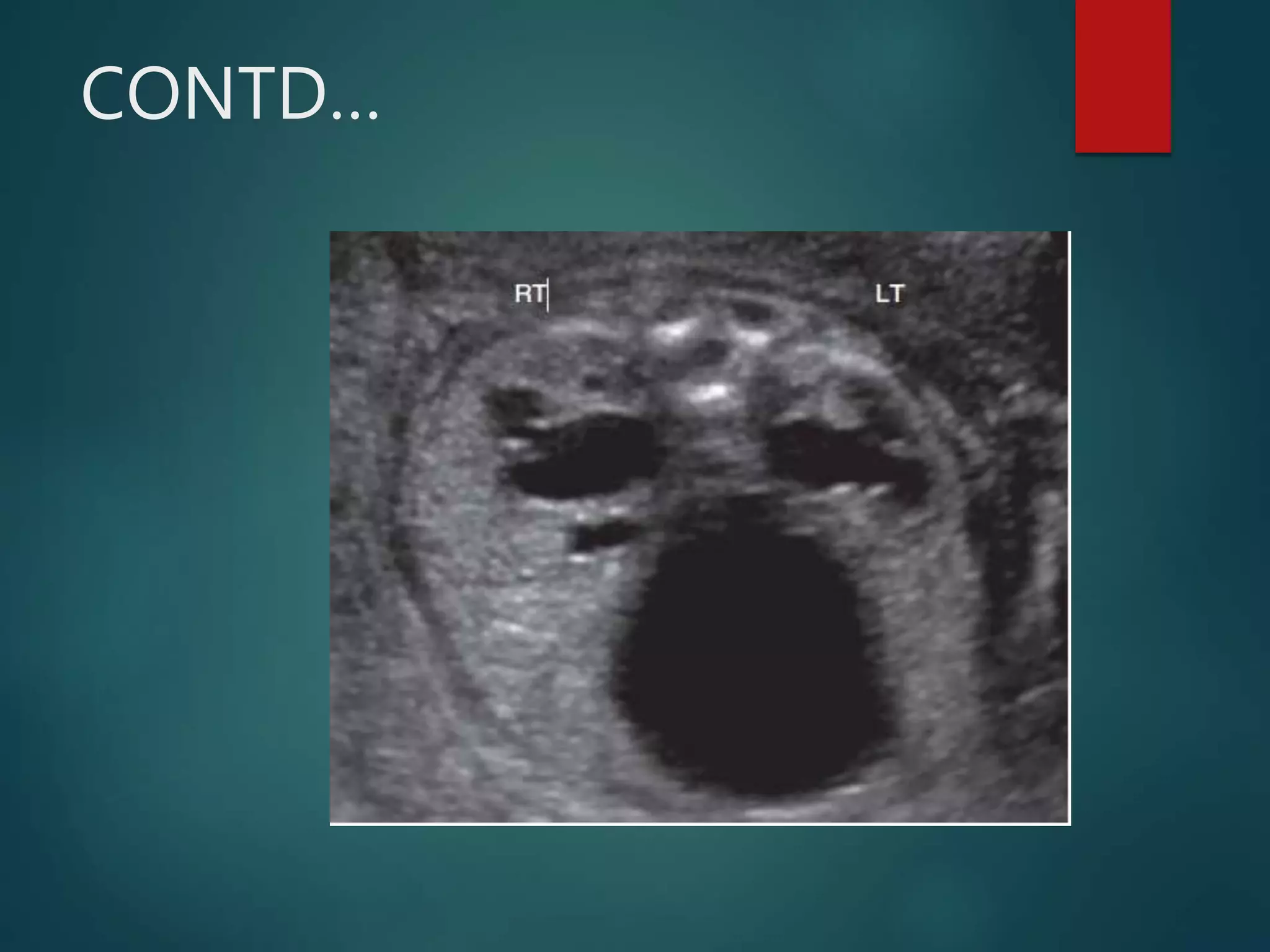 POSTERIOR URETERAL VALVES (PUV ) | PPTX