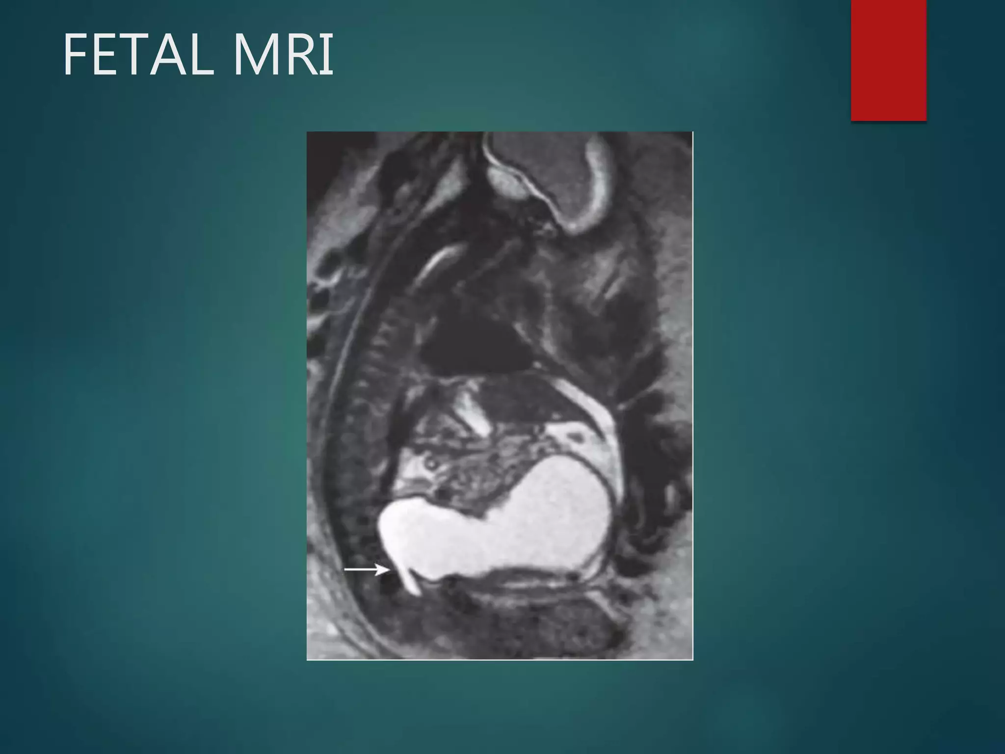 POSTERIOR URETERAL VALVES (PUV ) | PPTX