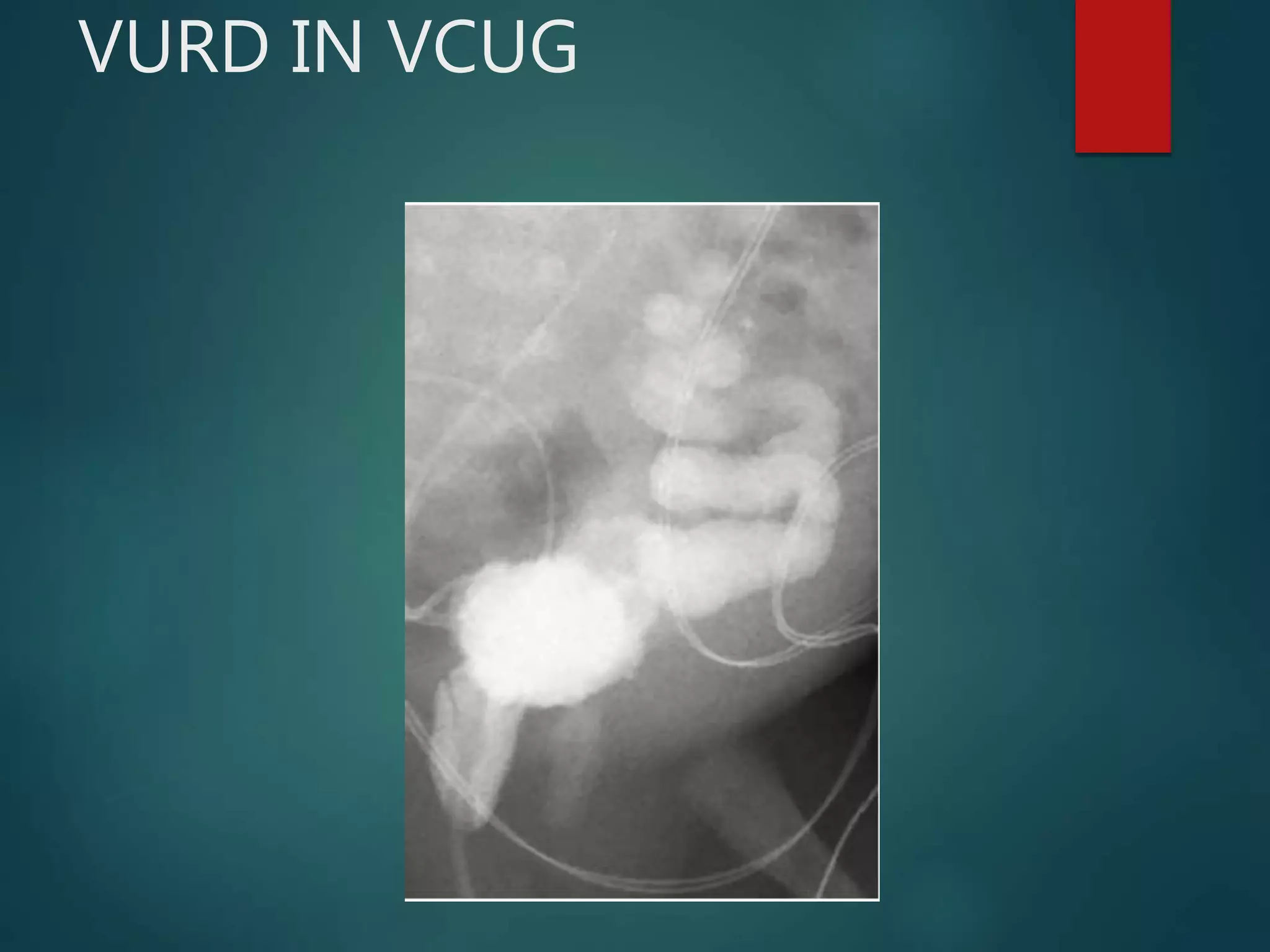 POSTERIOR URETERAL VALVES (PUV ) | PPTX