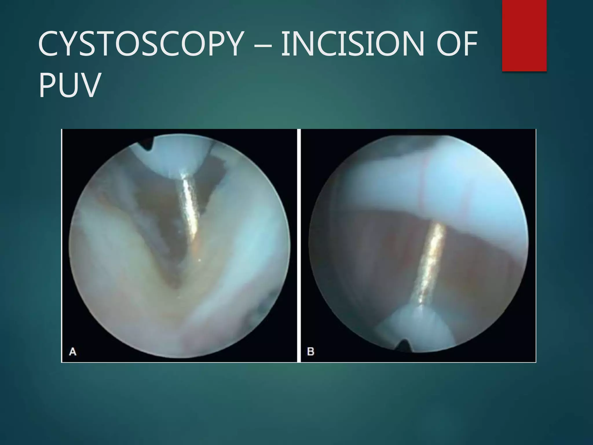 POSTERIOR URETERAL VALVES (PUV ) | PPTX