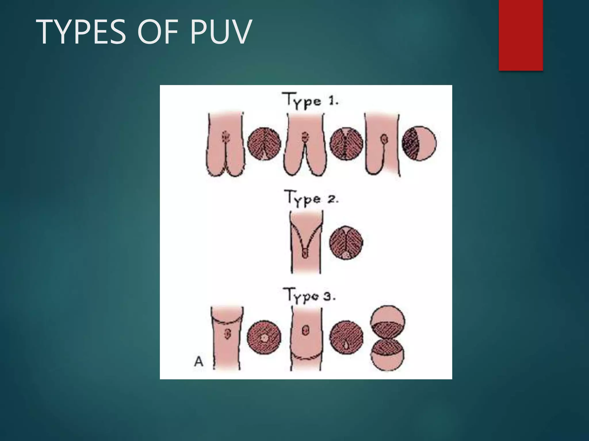 POSTERIOR URETERAL VALVES (PUV ) | PPTX