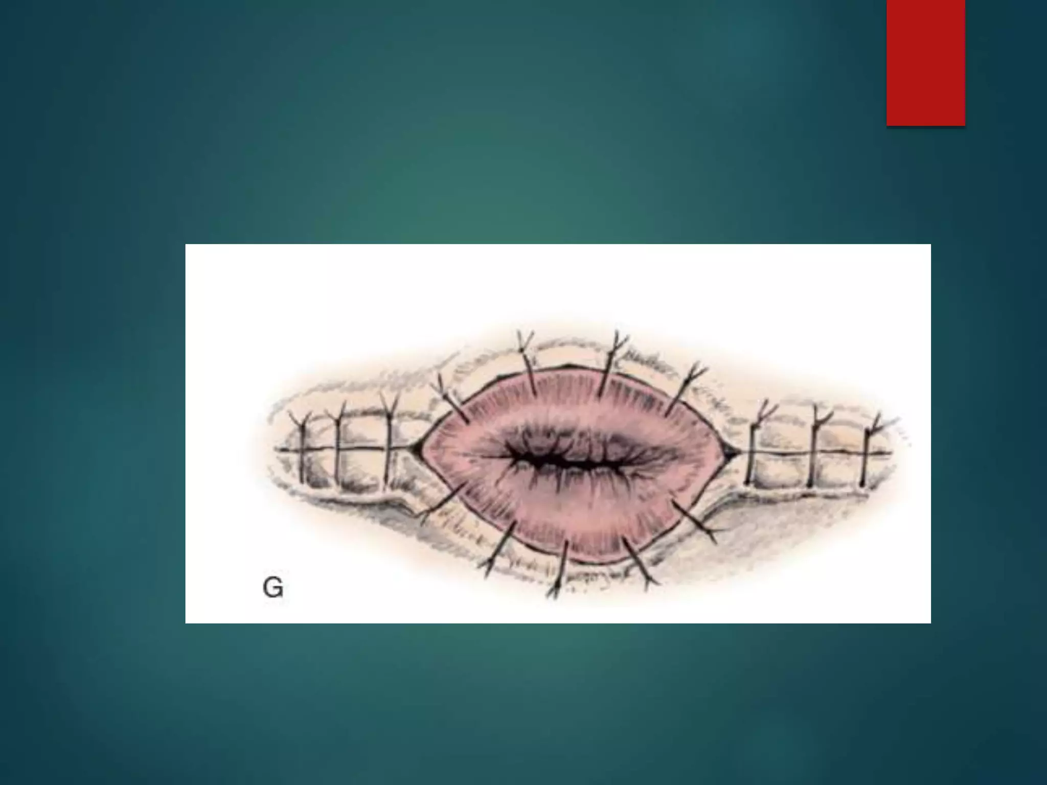 POSTERIOR URETERAL VALVES (PUV ) | PPTX
