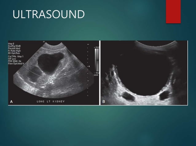 POSTERIOR URETERAL VALVES (PUV ) | PPTX
