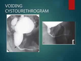 POSTERIOR URETERAL VALVES (PUV ) | PPTX