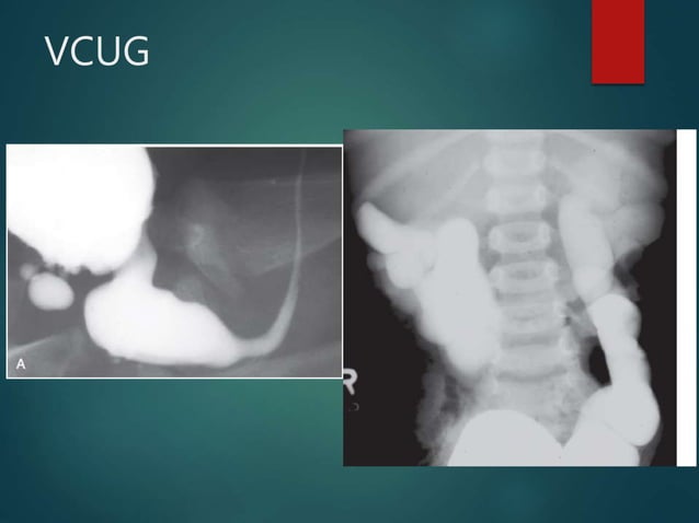 POSTERIOR URETERAL VALVES (PUV ) | PPTX