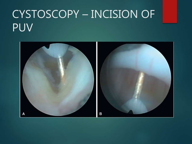 POSTERIOR URETERAL VALVES (PUV ) | PPTX
