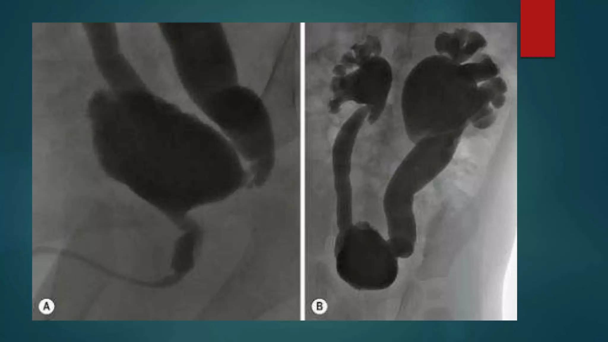 Posterior Urethral Valves | PPTX