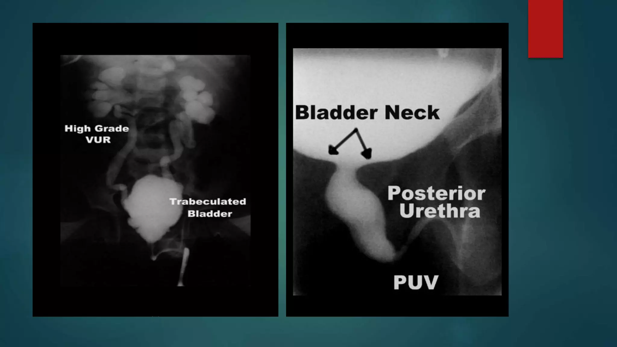 Posterior Urethral Valves | PPTX