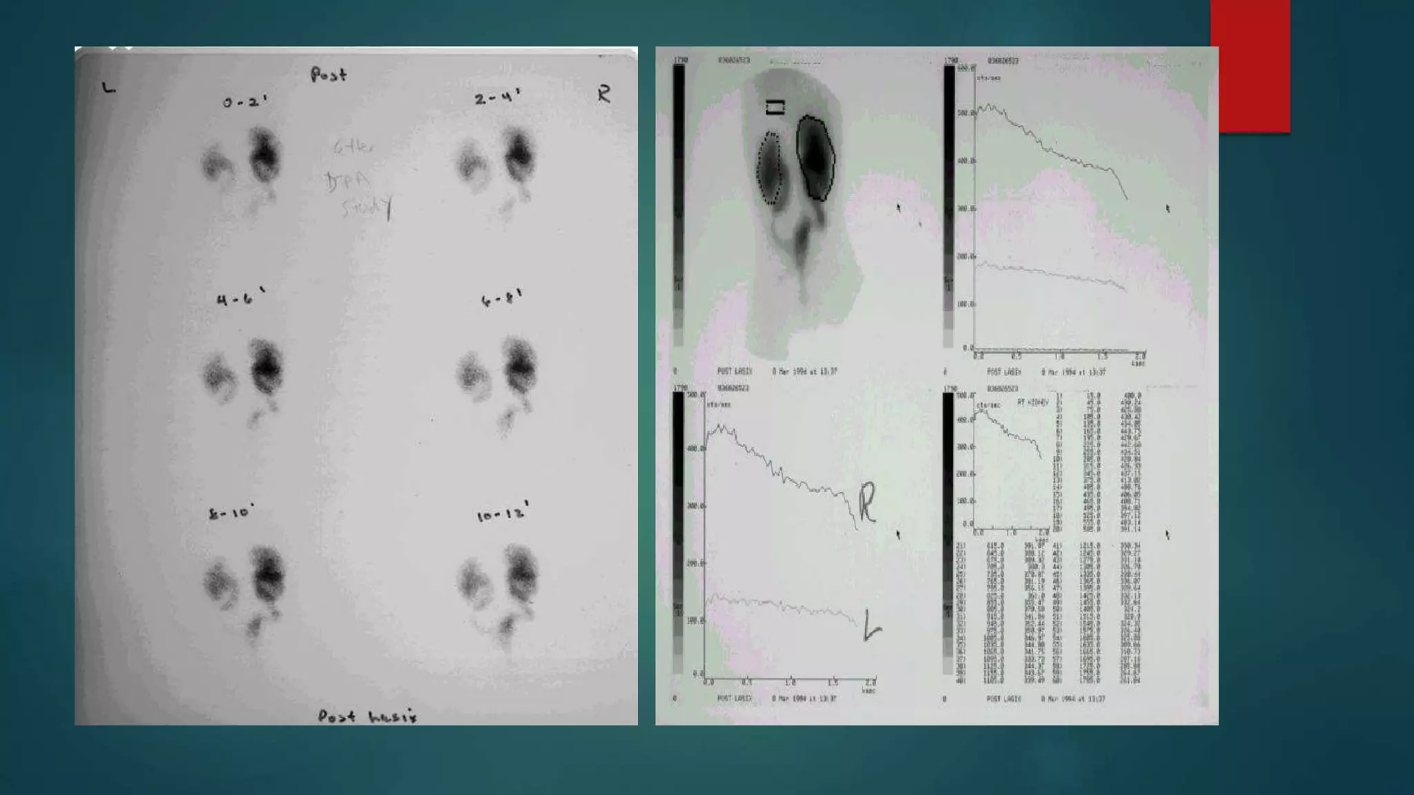 Posterior Urethral Valves | PPTX
