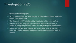 Posterior Urethral Valves | PPTX