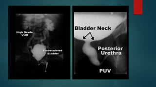Posterior Urethral Valves | PPTX