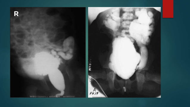 Posterior Urethral Valves | PPTX