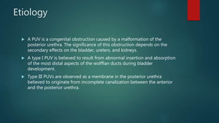 Posterior Urethral Valves | PPTX