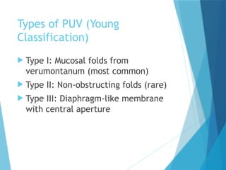 Posterior_Urethral_Valves_Detailed .pptx