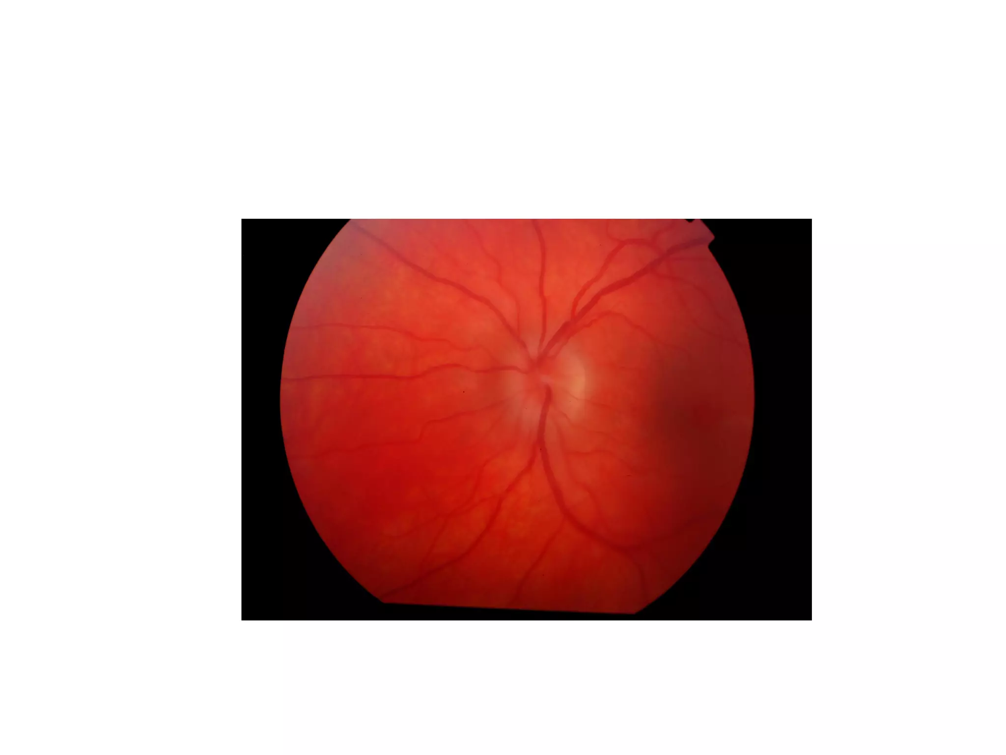 Posterior uveitis | PPT
