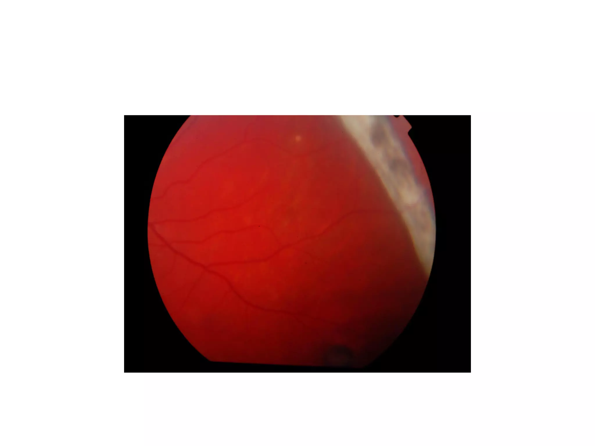 Posterior uveitis | PPT