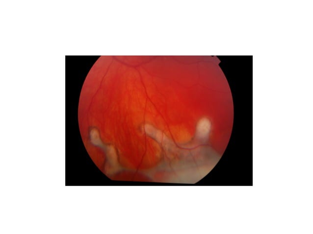 Posterior uveitis | PPT | Eye and Vision Conditions | Diseases and ...