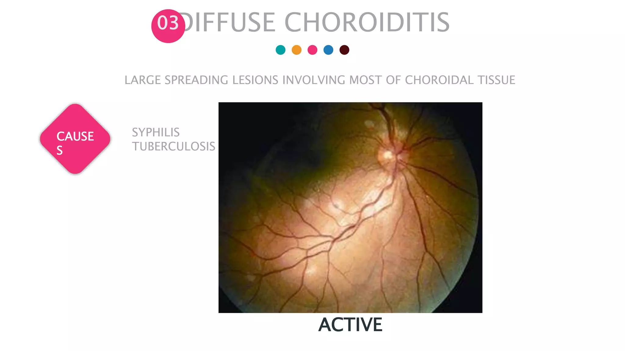 Posterior uveitis | PPTX
