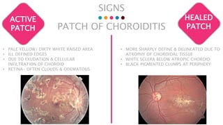 Posterior uveitis | PPTX