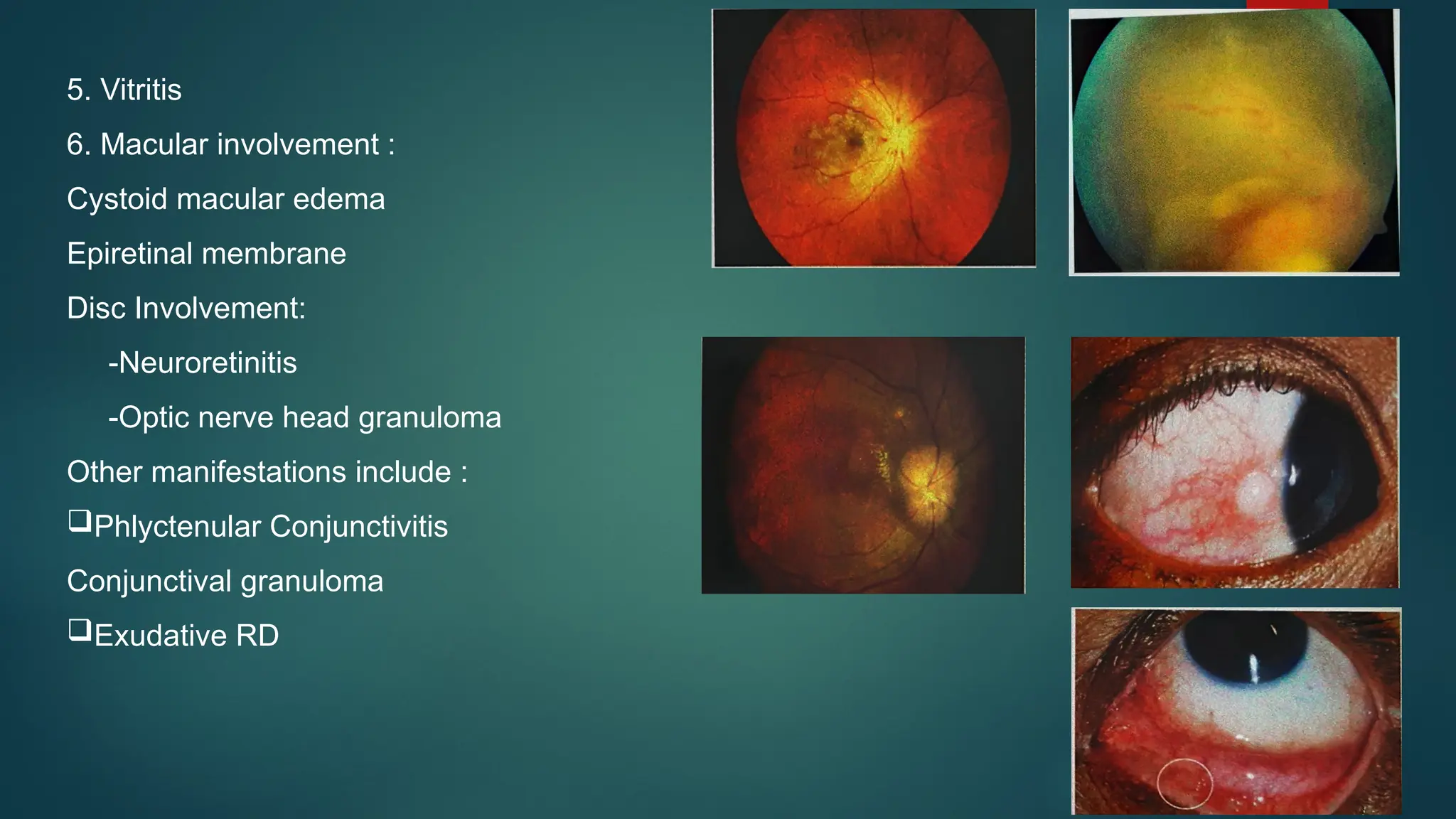 Posterior uveitis (Infective causes) Ophthalmology | PPTX