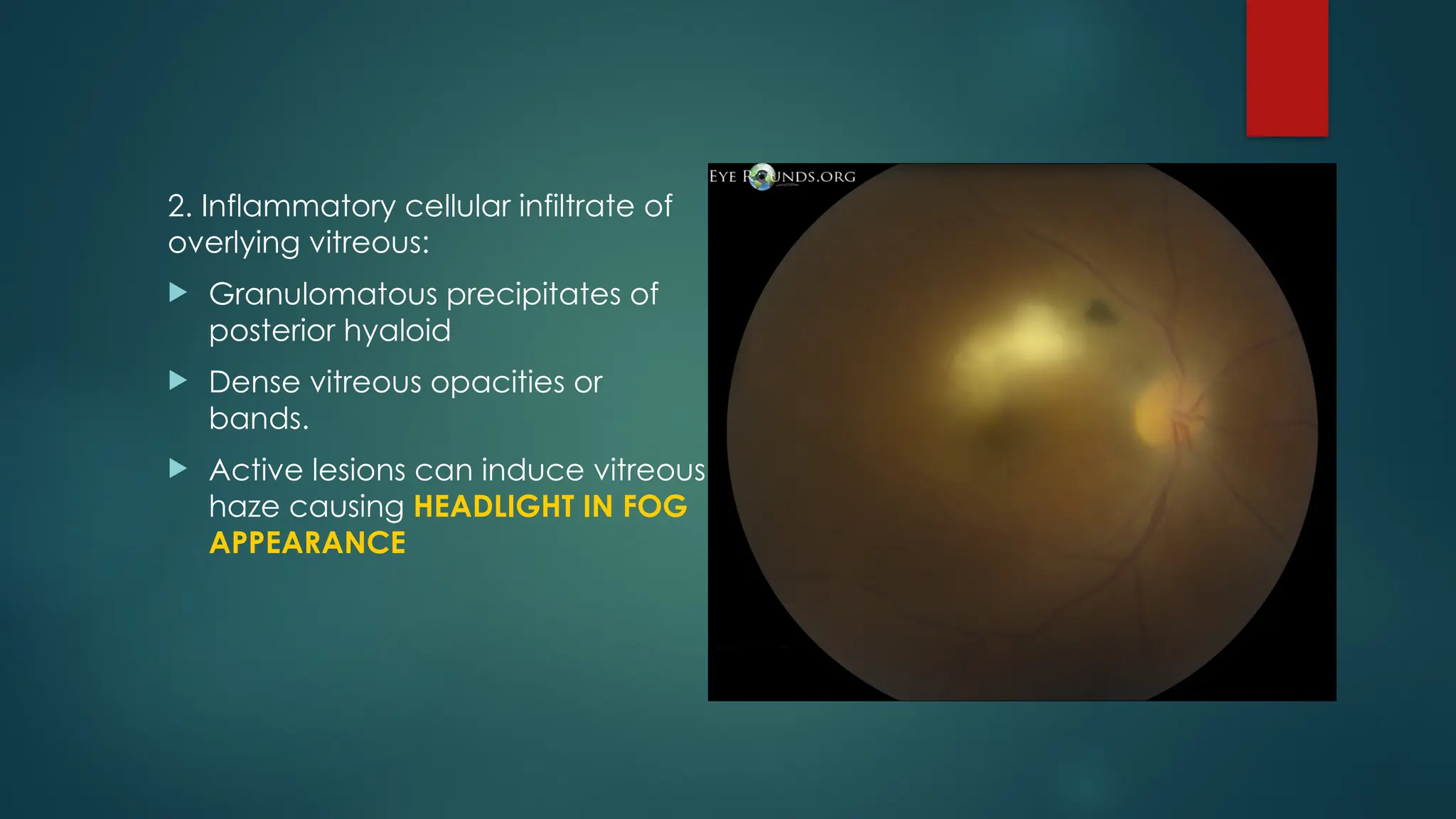 Posterior uveitis (Infective causes) Ophthalmology | PPTX