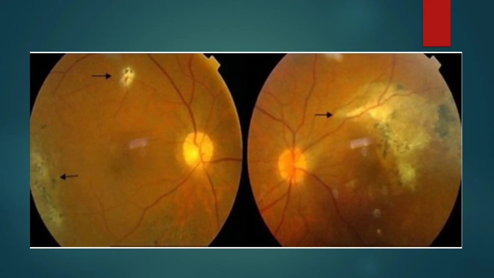Posterior uveitis (Infective causes) Ophthalmology | PPTX