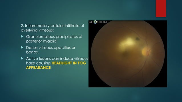 Posterior uveitis (Infective causes) Ophthalmology | PPTX