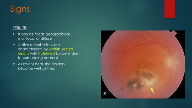 Posterior uveitis (Infective causes) Ophthalmology | PPTX