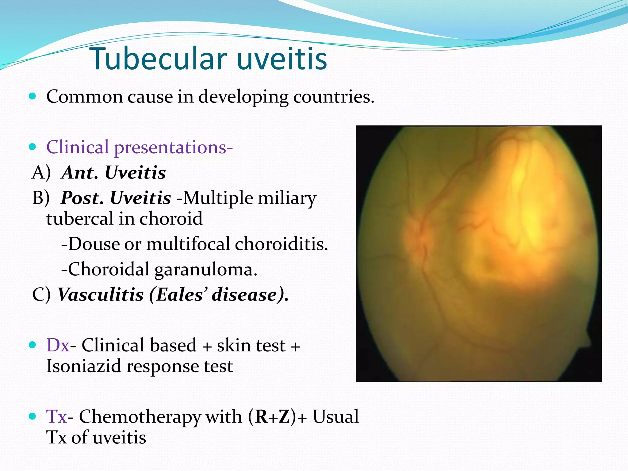 Posterior uveitis by Dr. VIJAY PRATAP VIPSY | PPTX