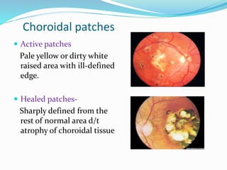 Posterior uveitis by Dr. VIJAY PRATAP VIPSY | PPTX