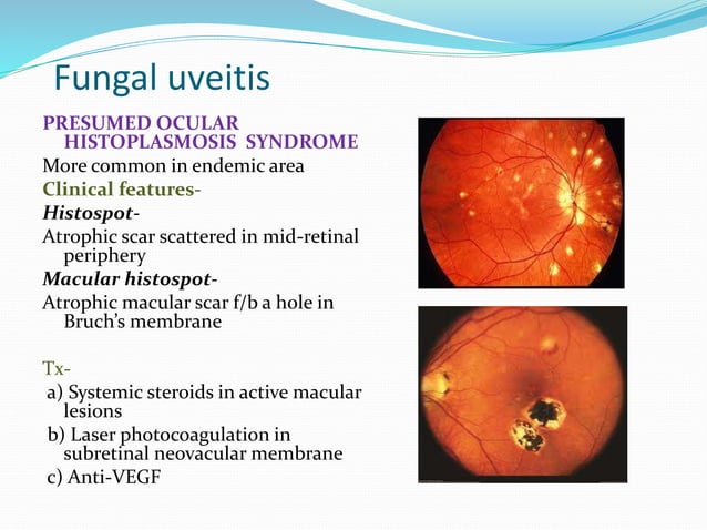 Posterior uveitis by Dr. VIJAY PRATAP VIPSY | PPTX | Eye and Vision ...