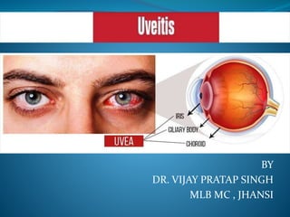 Intermediate Uveitis