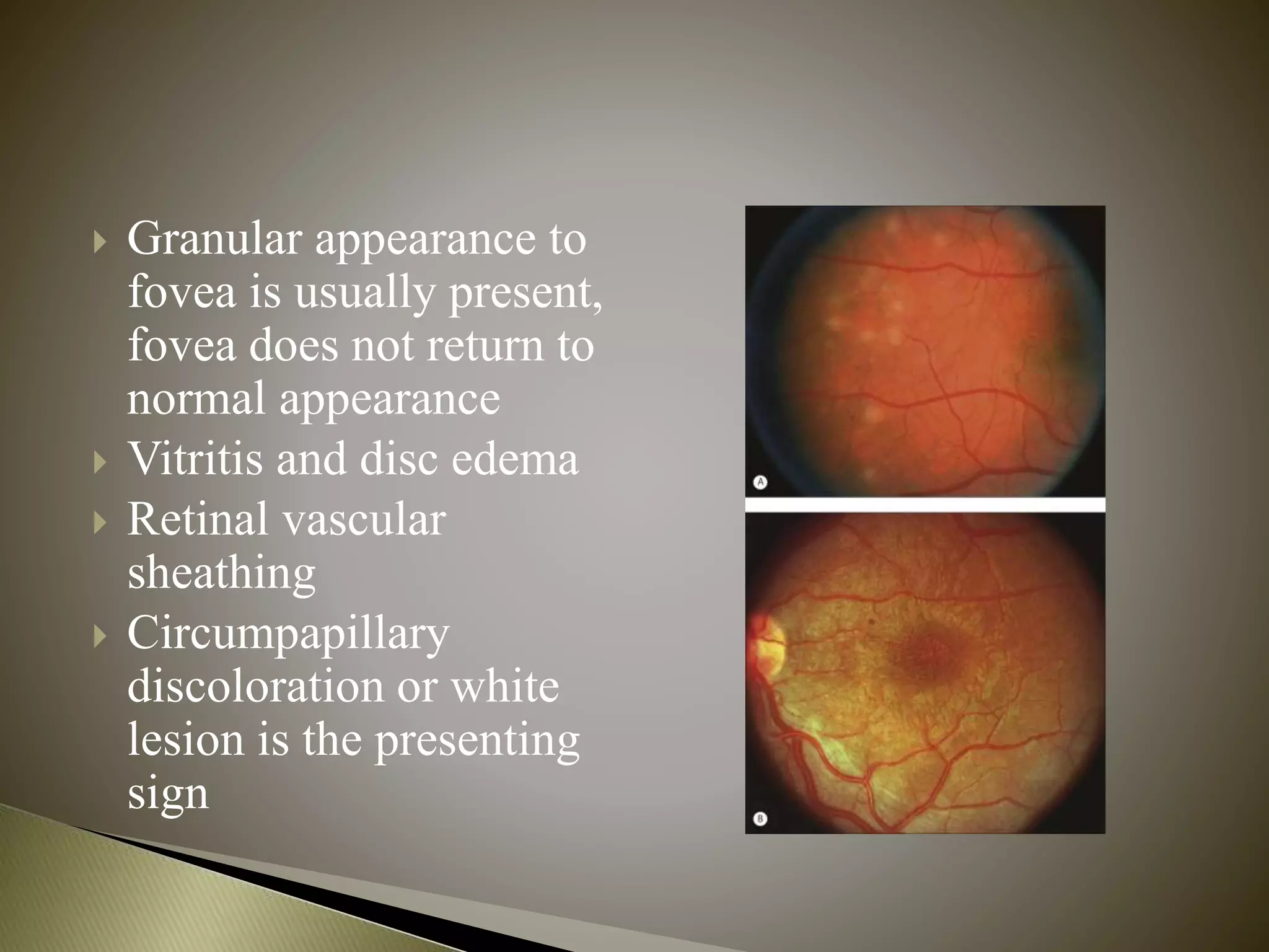Posterior uveitis of unknown cause white spot syndromes | PPT