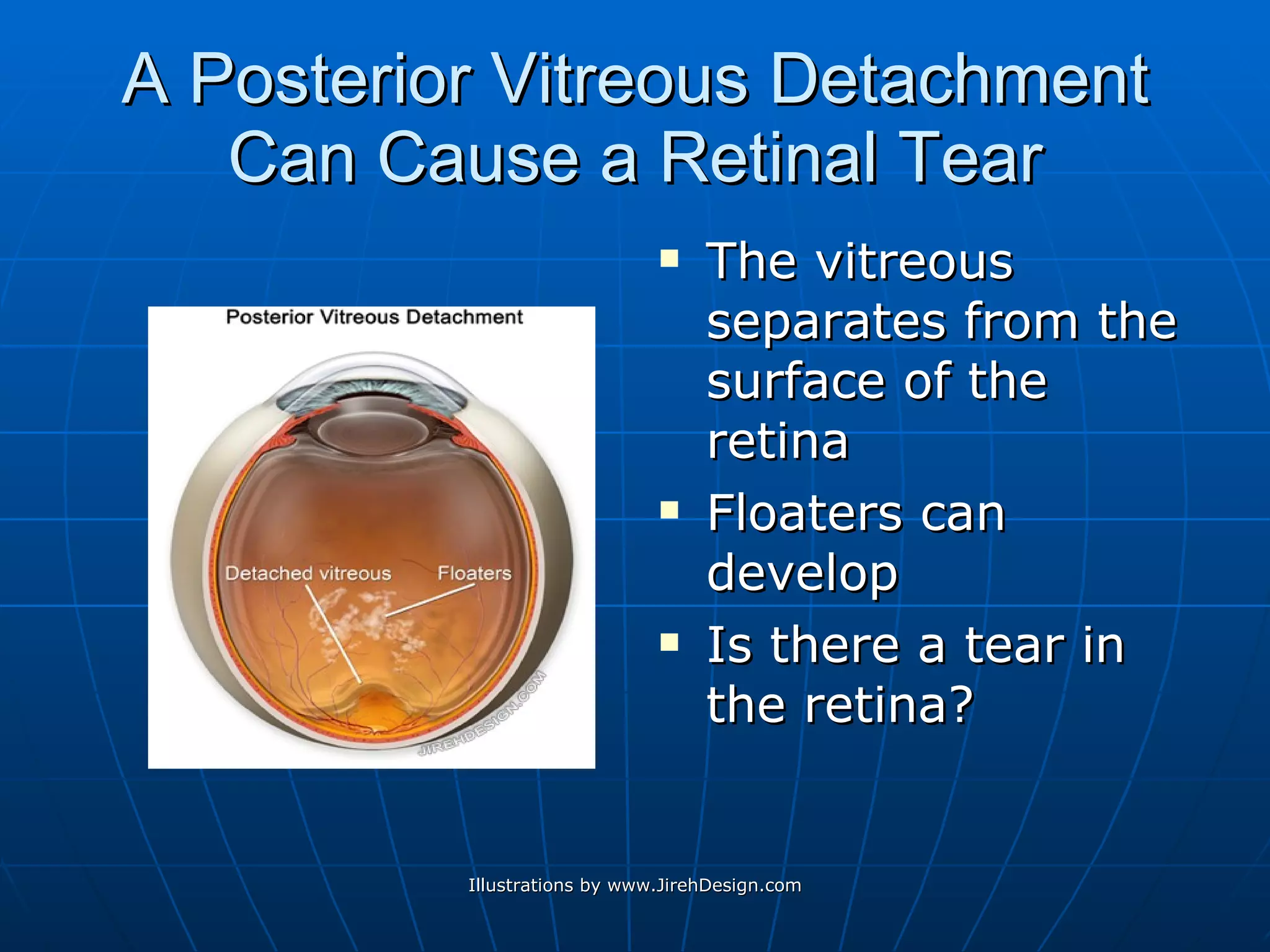 Posterior Vitreous Detachment | PPT