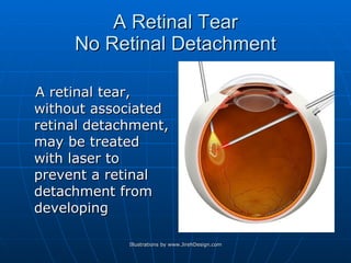 Posterior Vitreous Detachment | PPT