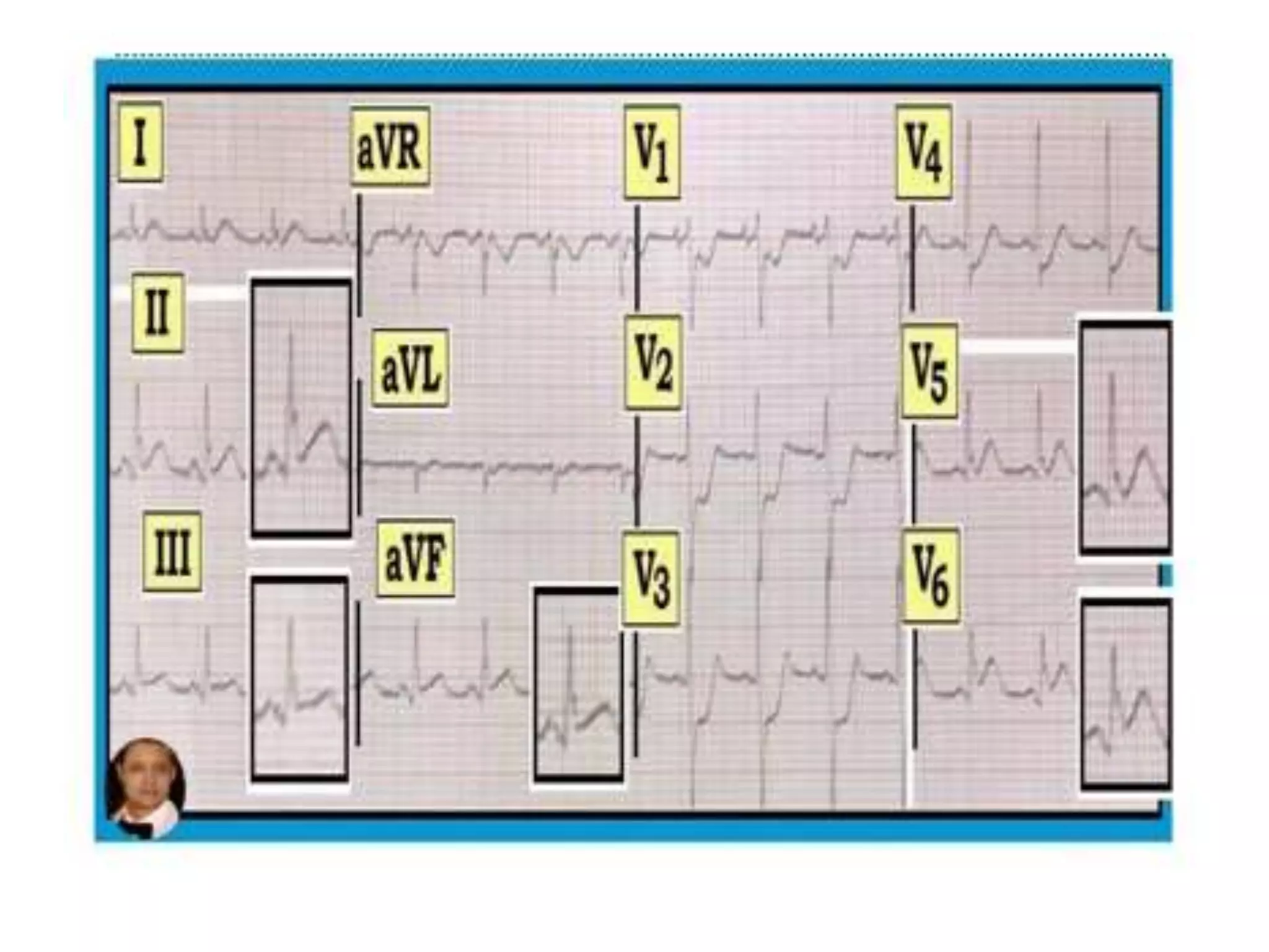 Posterior wall infarct by dr bashir ahmed dar associate professor medicine sopore kashmir | PPTX