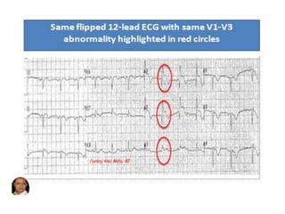 Posterior wall infarct by dr bashir ahmed dar associate professor medicine sopore kashmir | PPTX