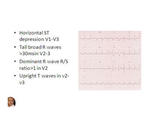 Posterior wall infarct by dr bashir ahmed dar associate professor medicine sopore kashmir | PPTX