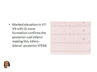 Posterior wall infarct by dr bashir ahmed dar associate professor medicine sopore kashmir | PPTX