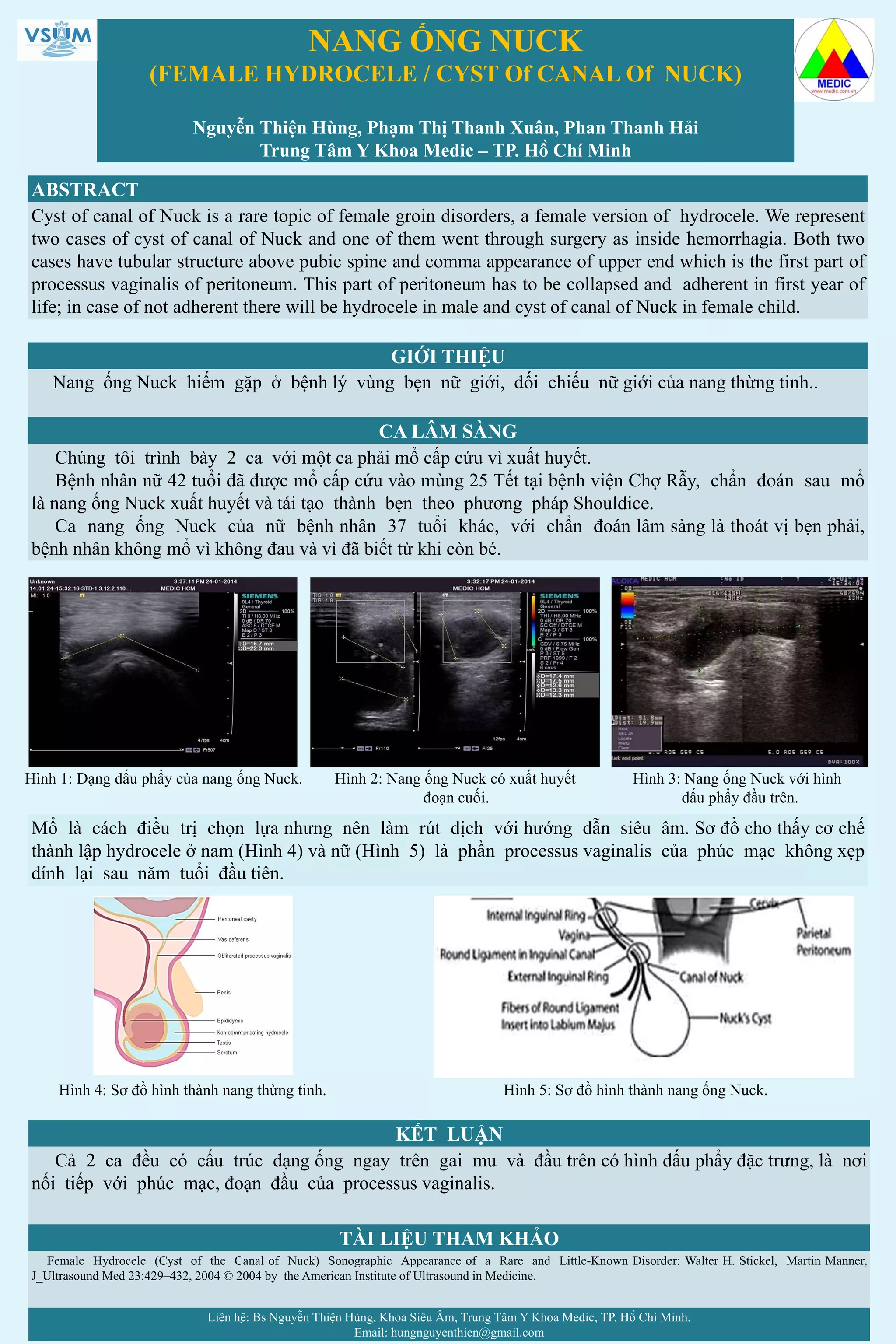 Poster FEMALE HYDROCELE [CYST of CANAL of NUCK], Dr PHAM THI THANH XUAN ...