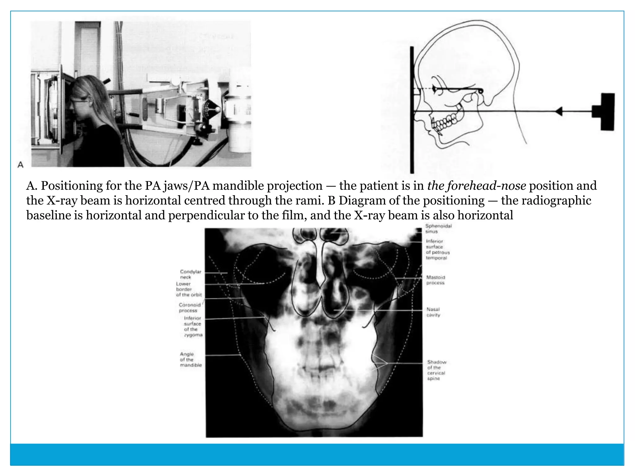 Postero anterior cephalometry | PPTX