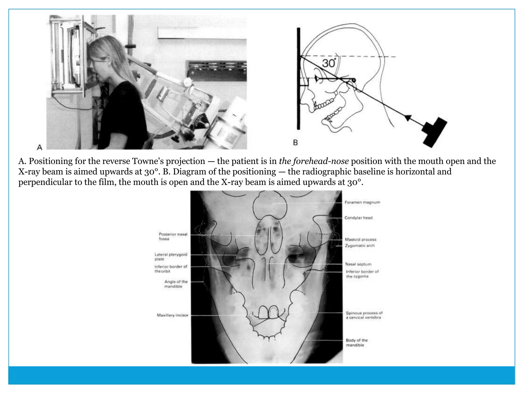 Postero anterior cephalometry | PPTX