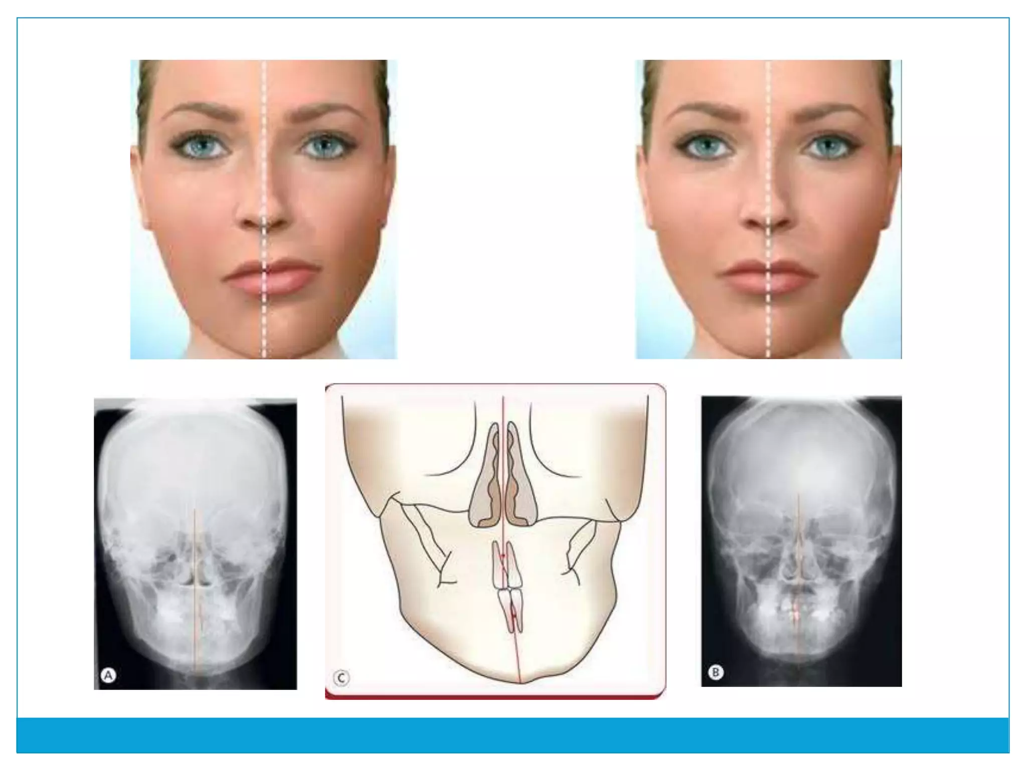 Postero anterior cephalometry | PPTX