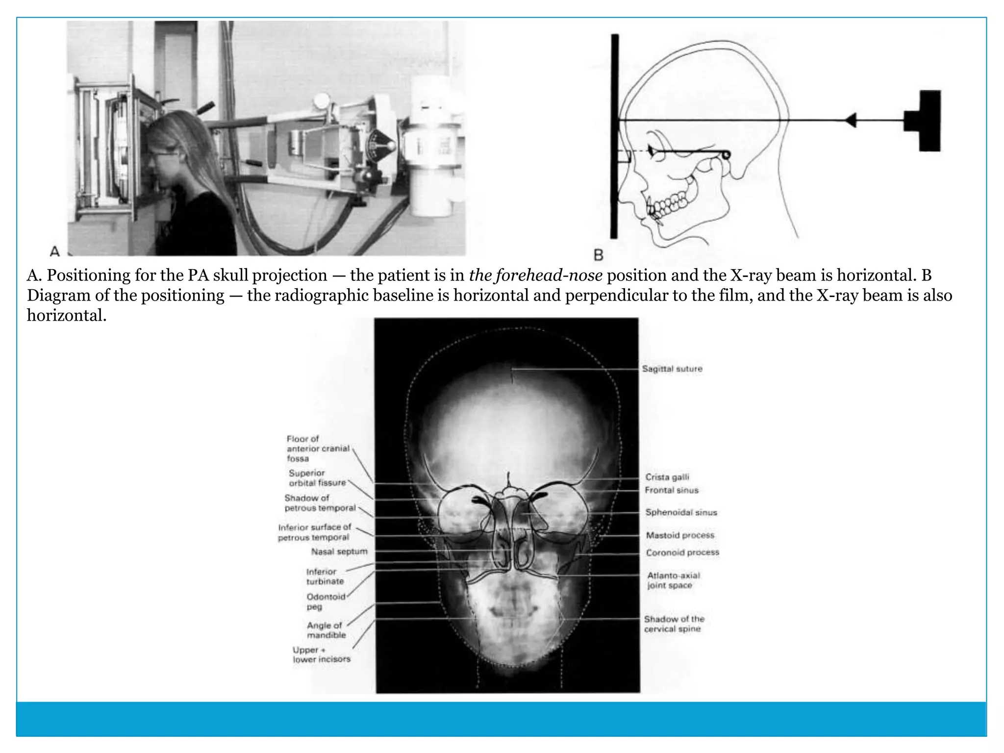Postero anterior cephalometry | PPTX